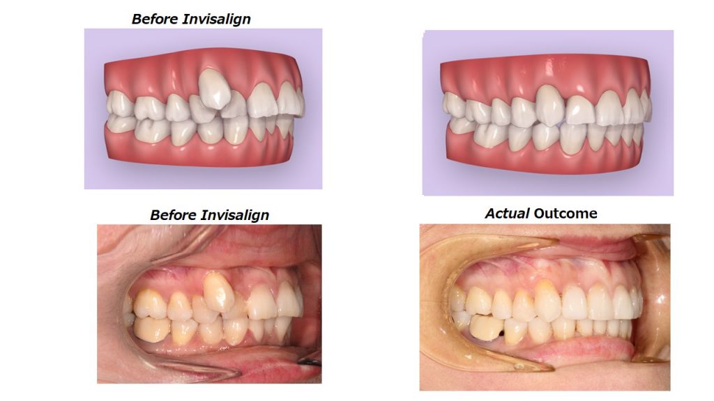 What kind of teeth should I have orthodontic treatment? - Dental Clinic ...