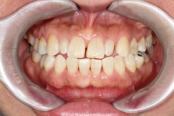 What kind of teeth should I have orthodontic treatment? - Dental Clinic ...