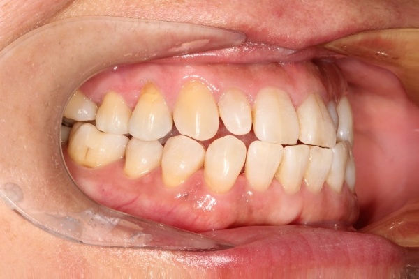 What kind of teeth should I have orthodontic treatment? - Dental Clinic ...