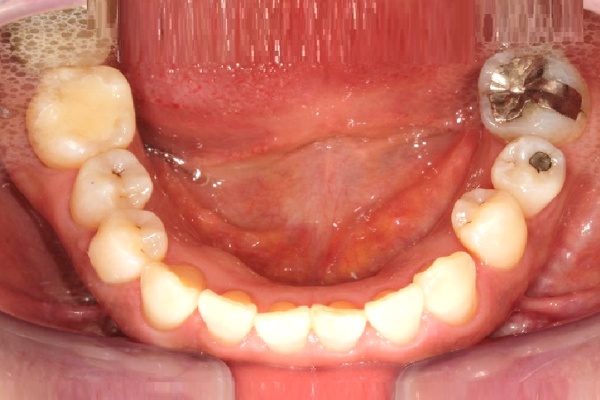 What kind of teeth should I have orthodontic treatment? - Dental Clinic ...