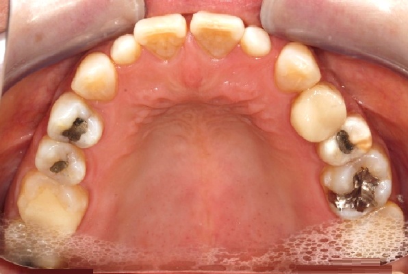 What kind of teeth should I have orthodontic treatment? - Dental Clinic ...